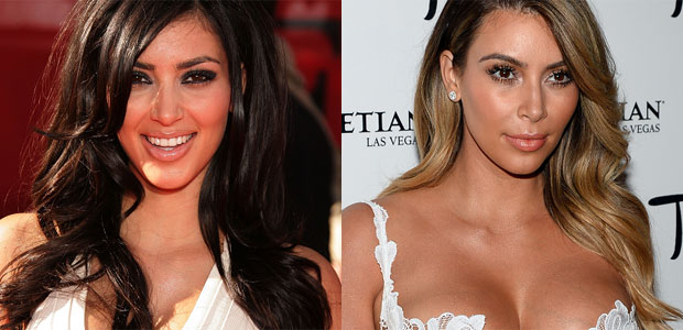 Kim Kardashian Fez Várias Cirurgias Plásticas Incluindo Botox E
